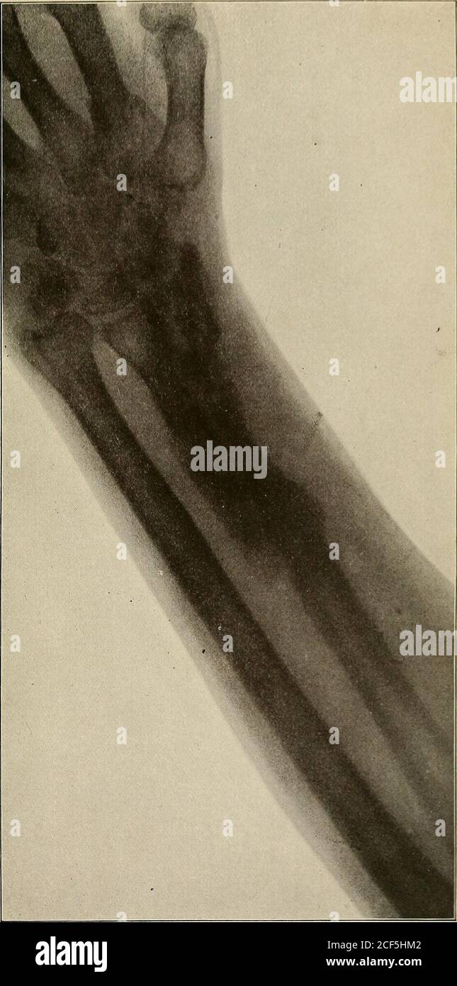 . A practical treatise on fractures and dislocations. Fracture of ...