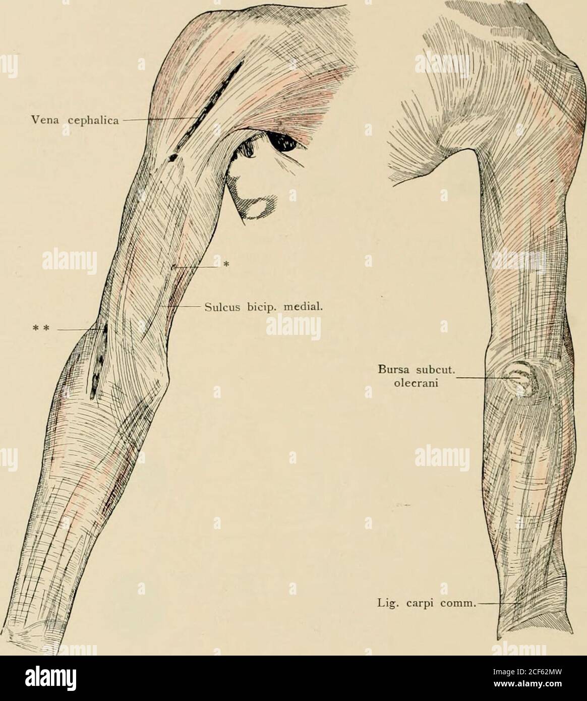Vena cephalica hi-res stock photography and images - Alamy
