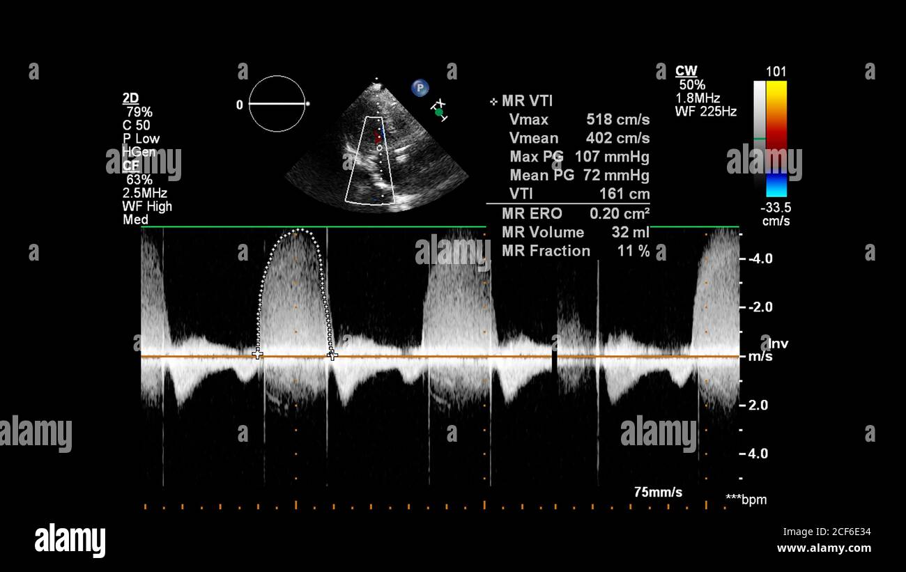 Transesophageal echocardiogram hi-res stock photography and images - Alamy