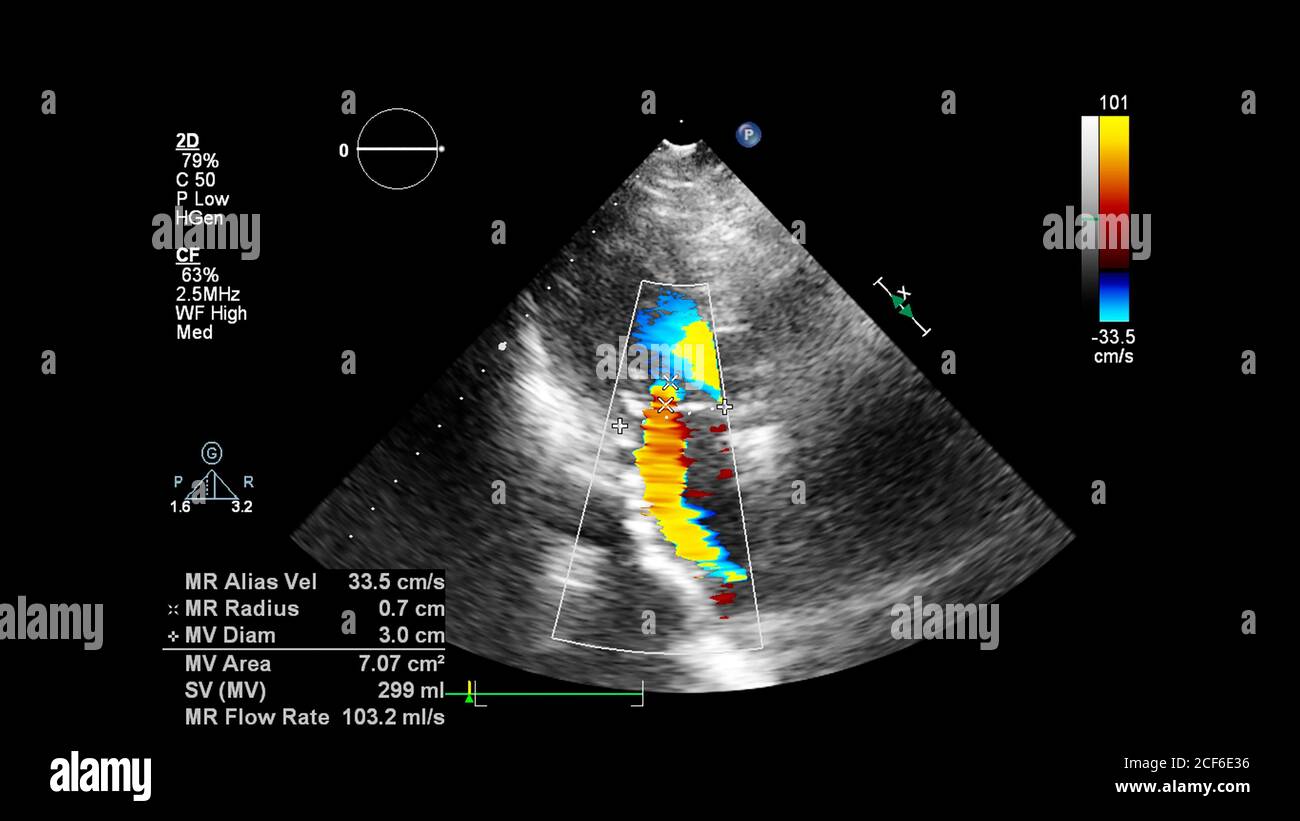 Transesophageal echocardiogram hi-res stock photography and images - Alamy