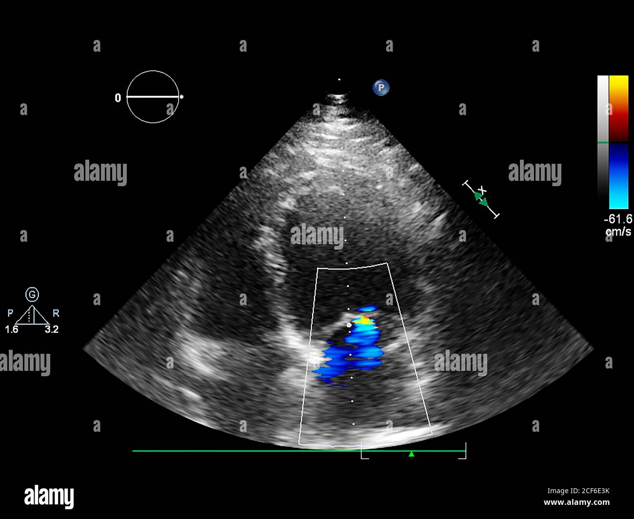 Image of the heart during transesophageal ultrasound with Doppler mode ...