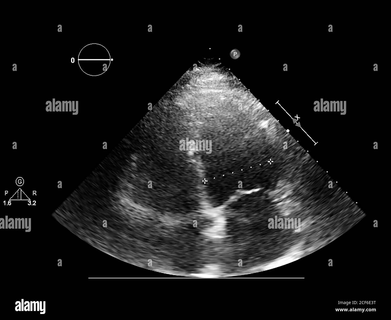 Image of the heart in gray-scale mode during transesophageal ultrasound ...