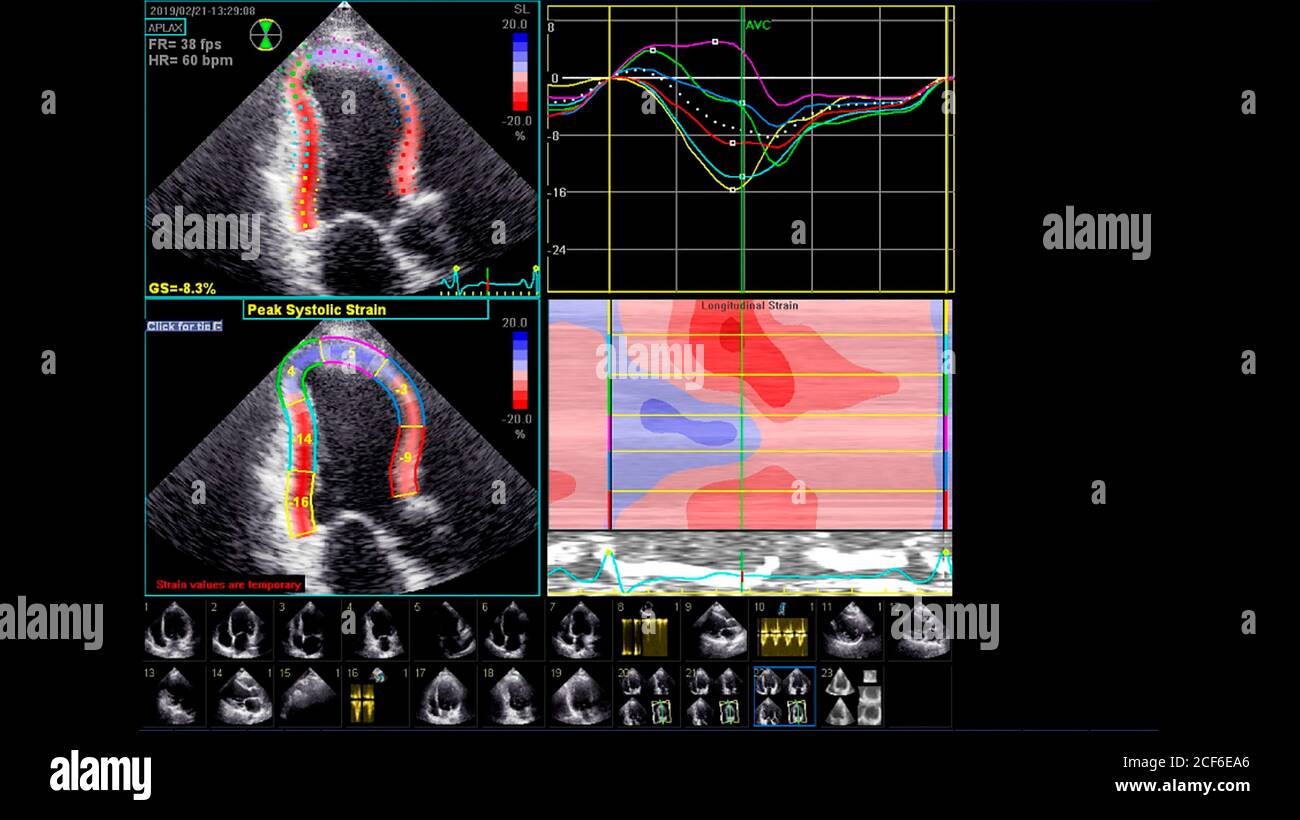 Image of the heart in gray-scale mode during transesophageal ultrasound ...