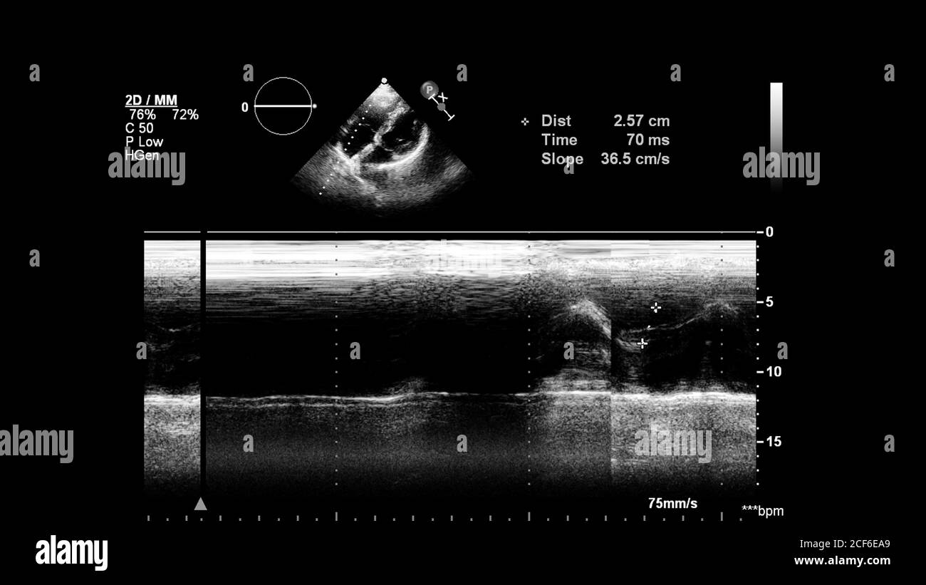 Image of the heart in gray-scale mode during transesophageal ultrasound ...