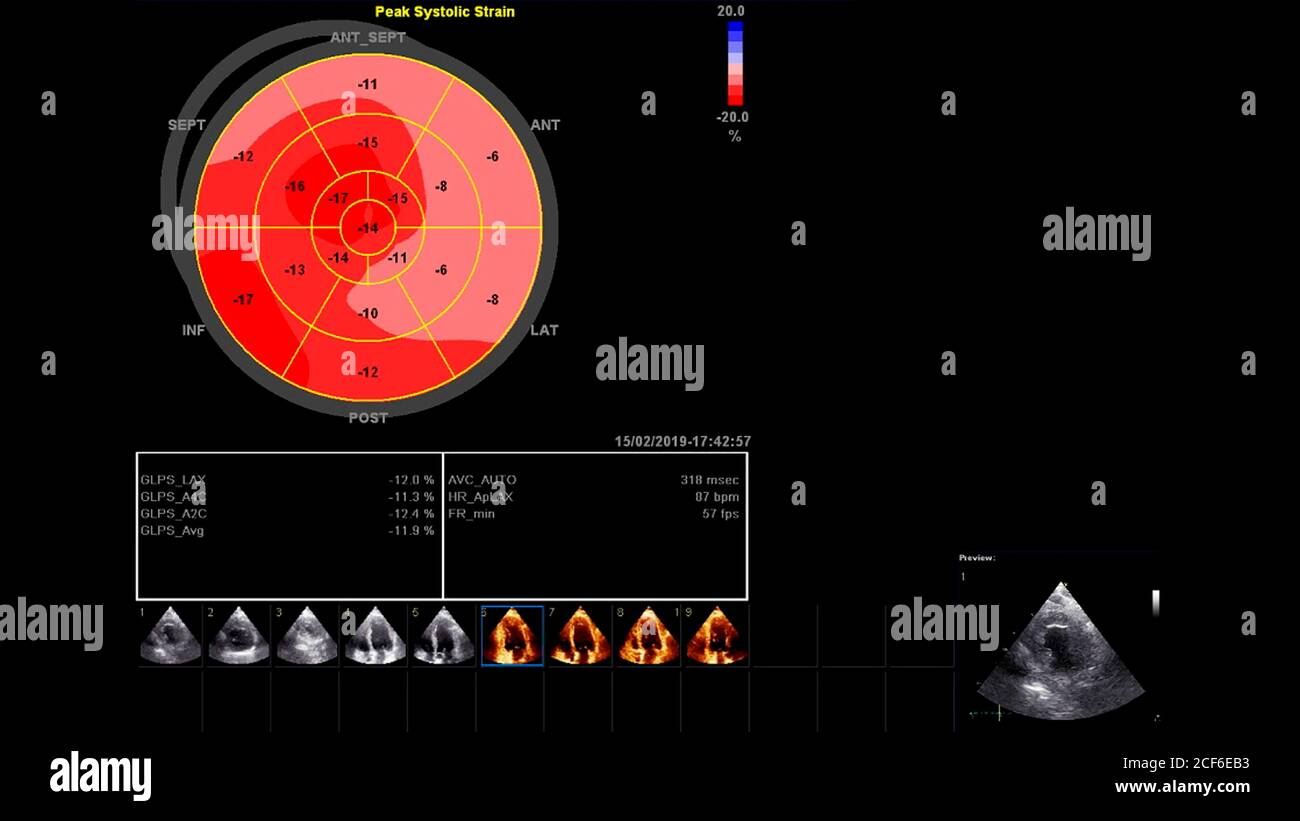 Image of the heart in gray-scale mode during transesophageal ultrasound ...