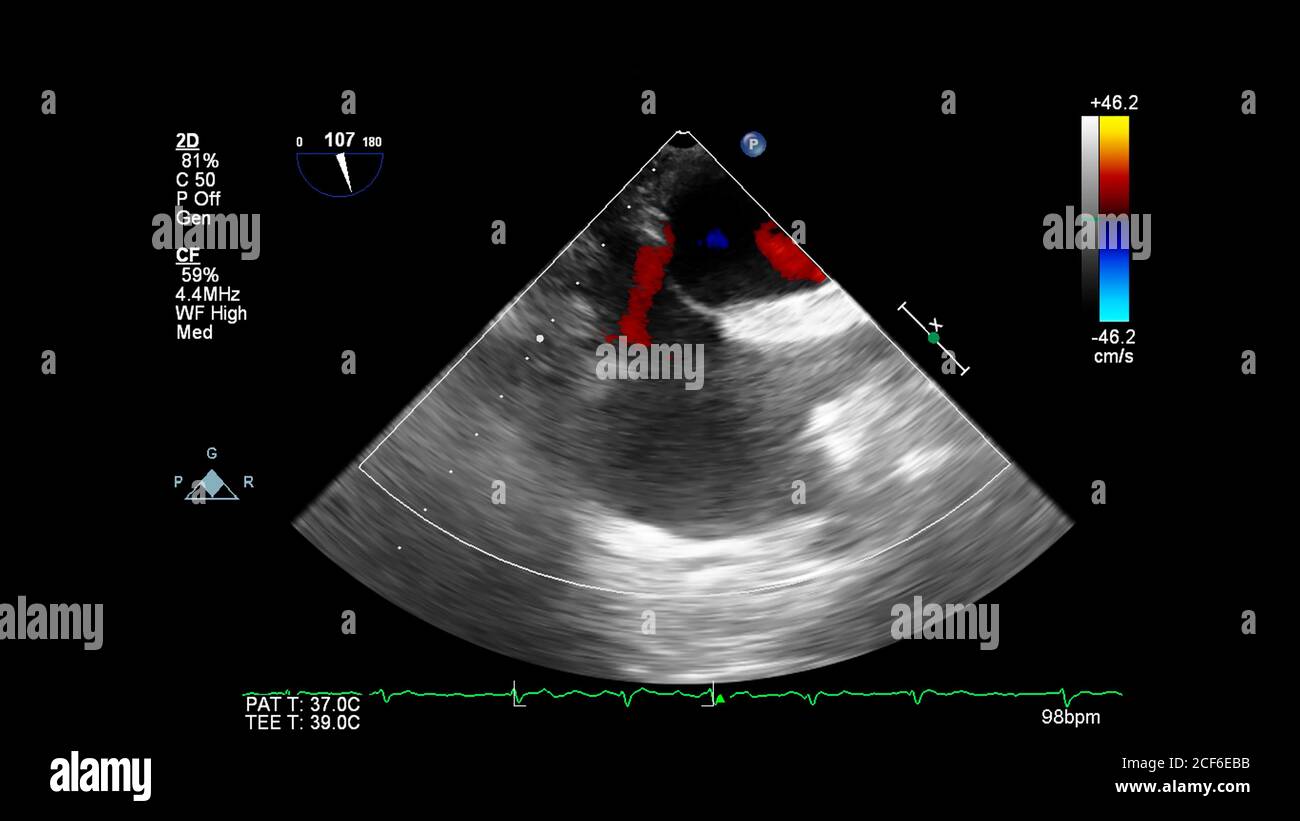 Transesophageal echocardiogram hi-res stock photography and images - Alamy