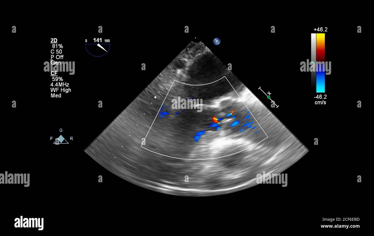 Aorta ultrasound hi-res stock photography and images - Alamy