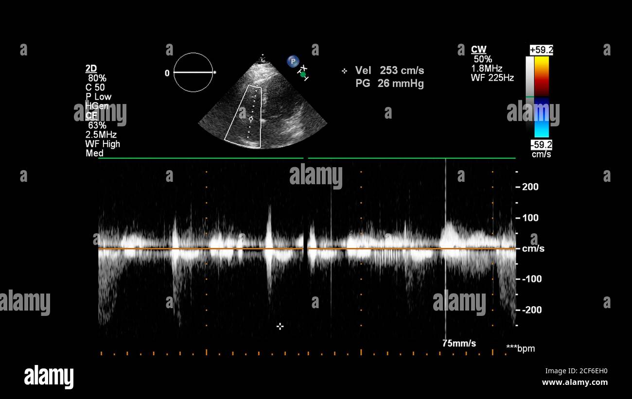 Image of the heart during transesophageal ultrasound with Doppler mode ...