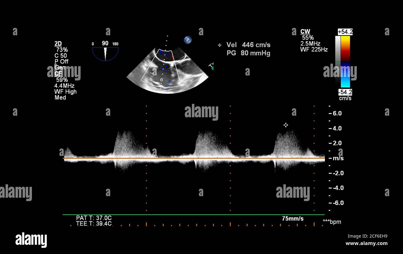 Image of the heart during transesophageal ultrasound with Doppler mode ...