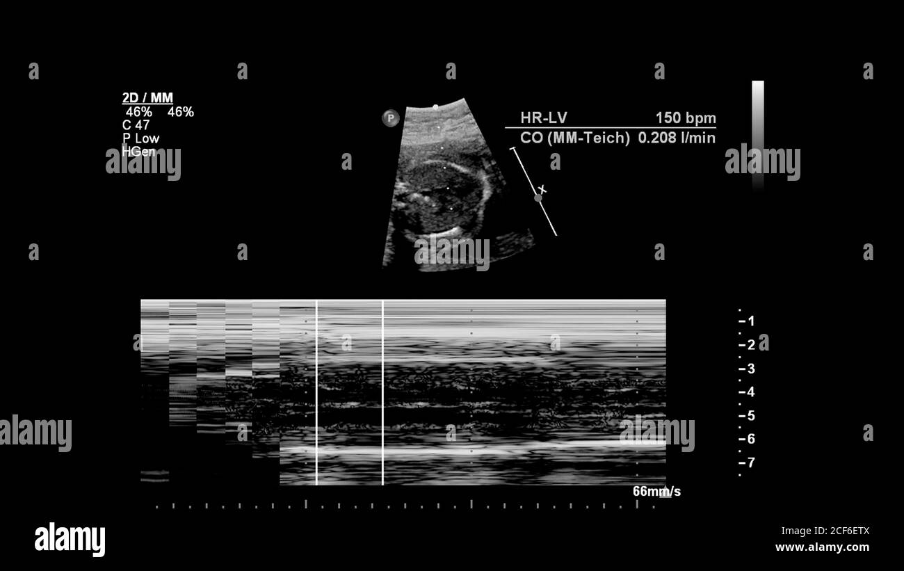 Ultrasound screen with fetal echocardiography Stock Photo - Alamy