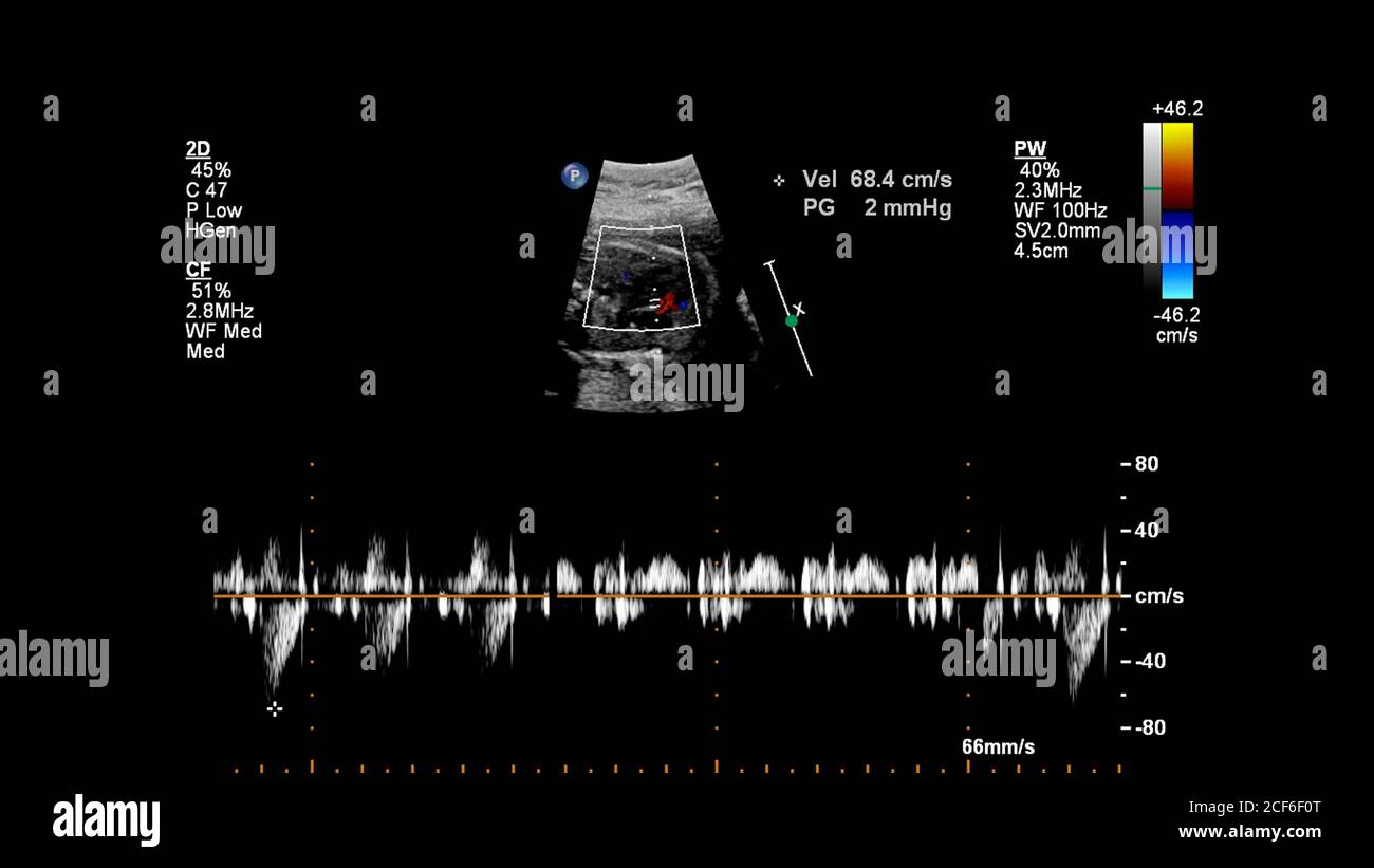 Ultrasound screen with fetal echocardiography Stock Photo - Alamy