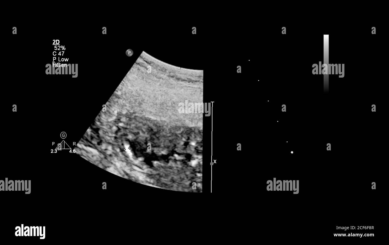 Ultrasound screen with fetal echocardiography Stock Photo - Alamy