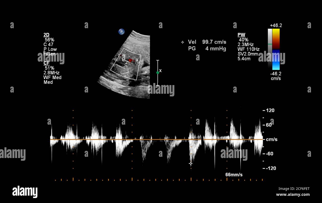 Ultrasound screen with fetal echocardiography Stock Photo - Alamy