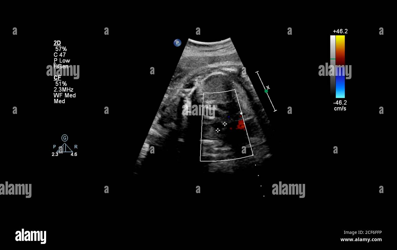 Ultrasound screen with fetal echocardiography Stock Photo - Alamy