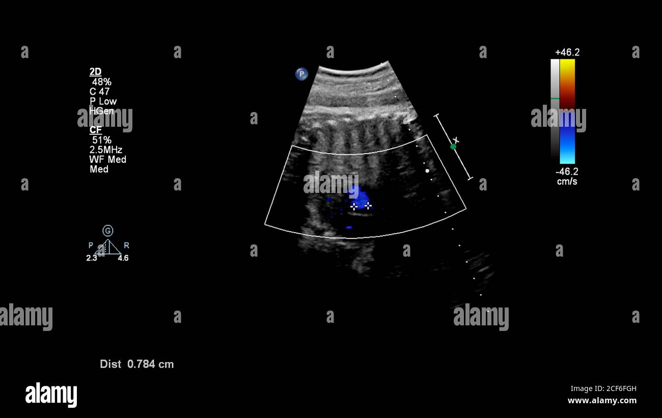Ultrasound screen with fetal echocardiography Stock Photo - Alamy