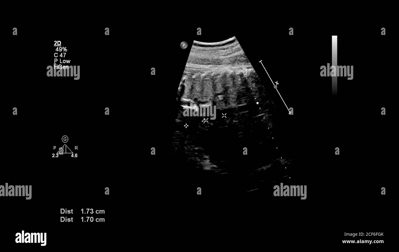Ultrasound screen with fetal echocardiography Stock Photo - Alamy