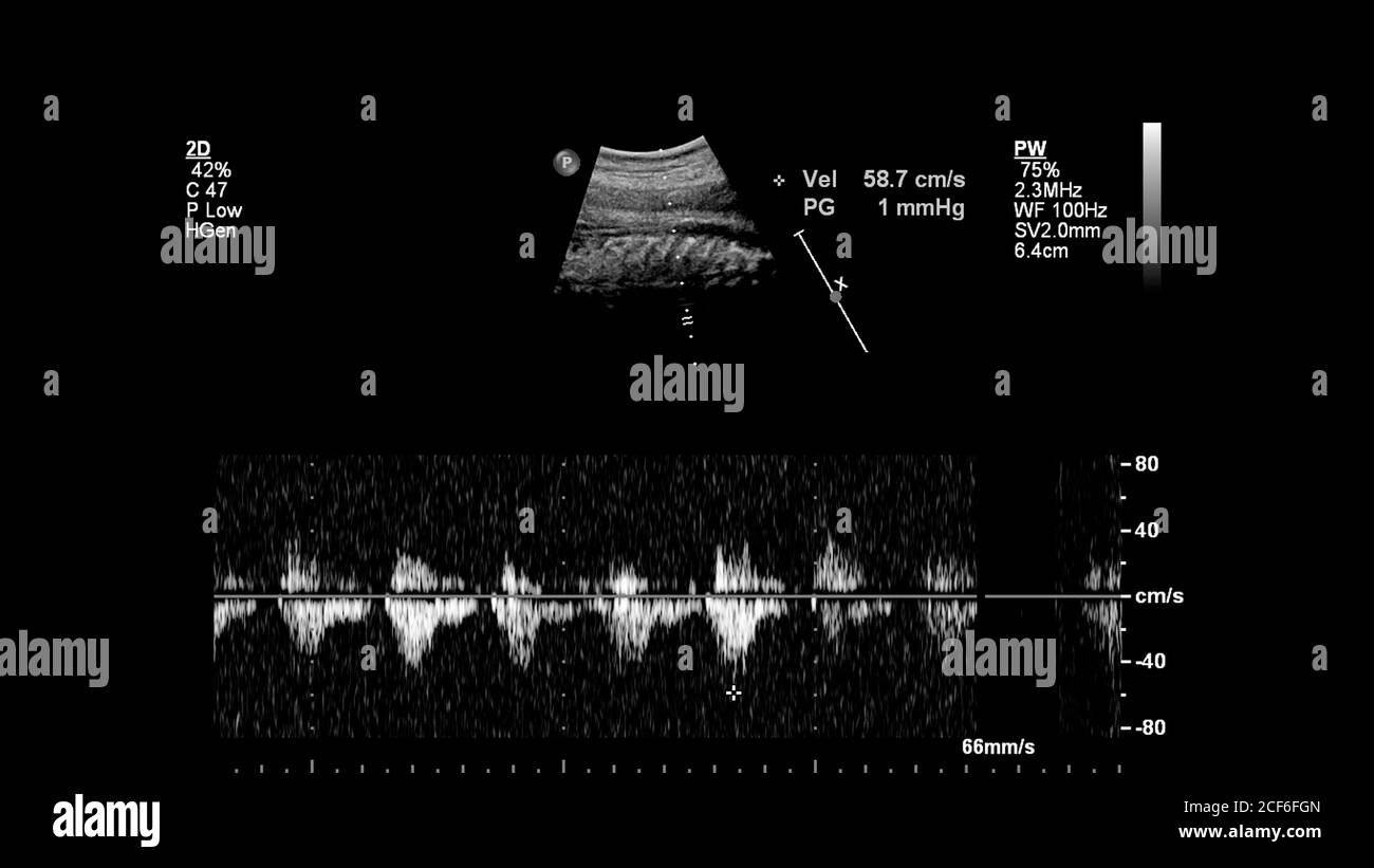 Ultrasound screen with fetal echocardiography Stock Photo - Alamy