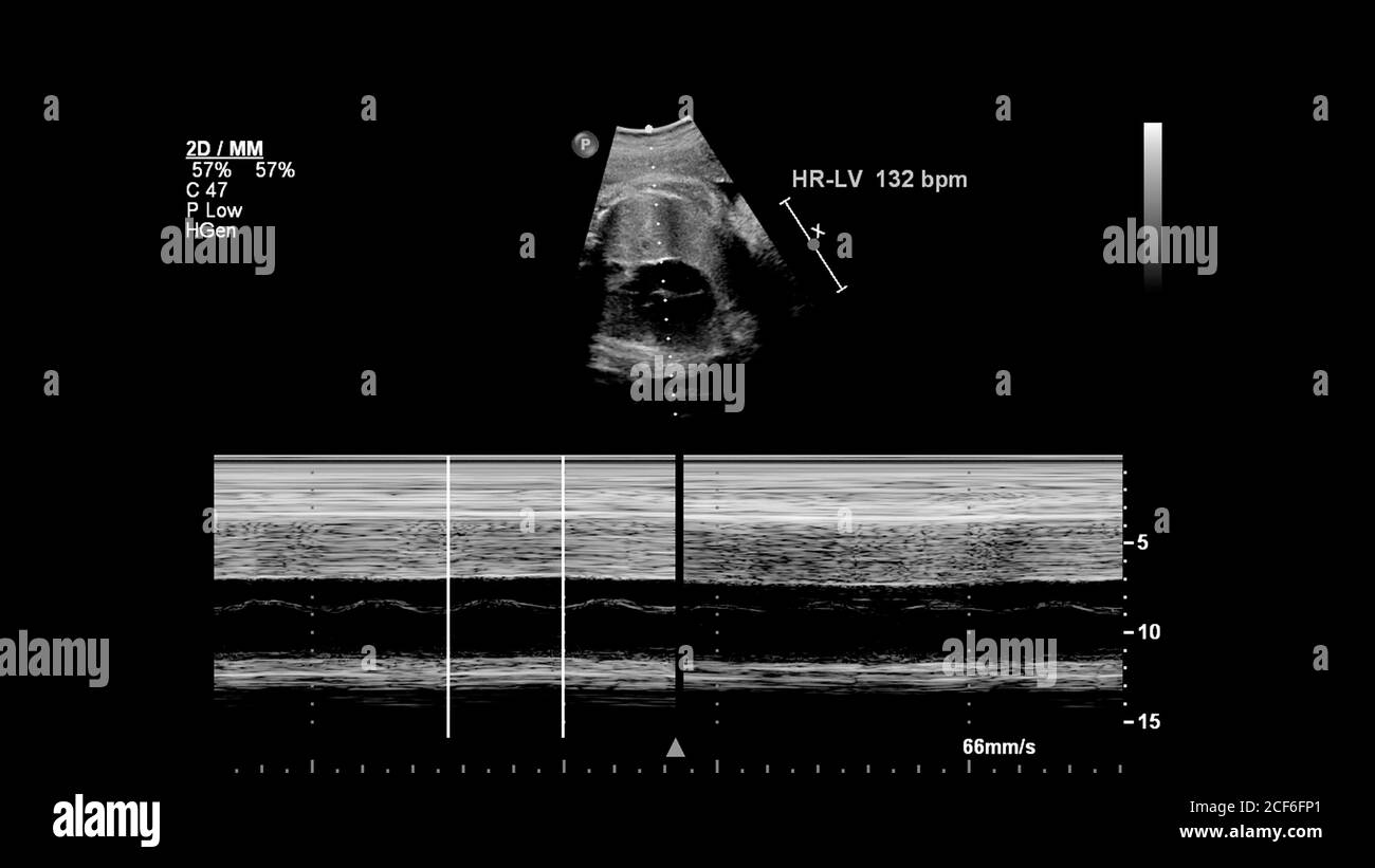 Ultrasound screen with fetal echocardiography Stock Photo - Alamy
