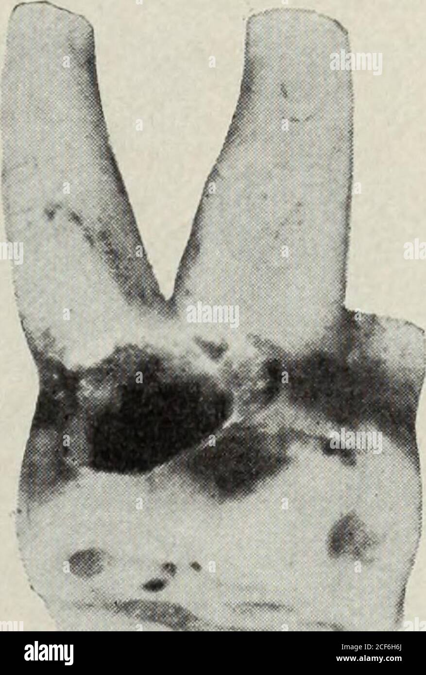. The Dental cosmos. ss around a molar that wasremoved because of an ...