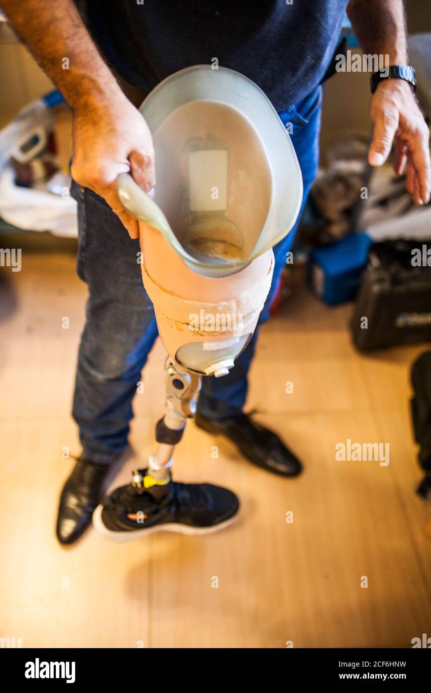 unrecognizable prosthetic engineer reviewing the prosthesis of a ...