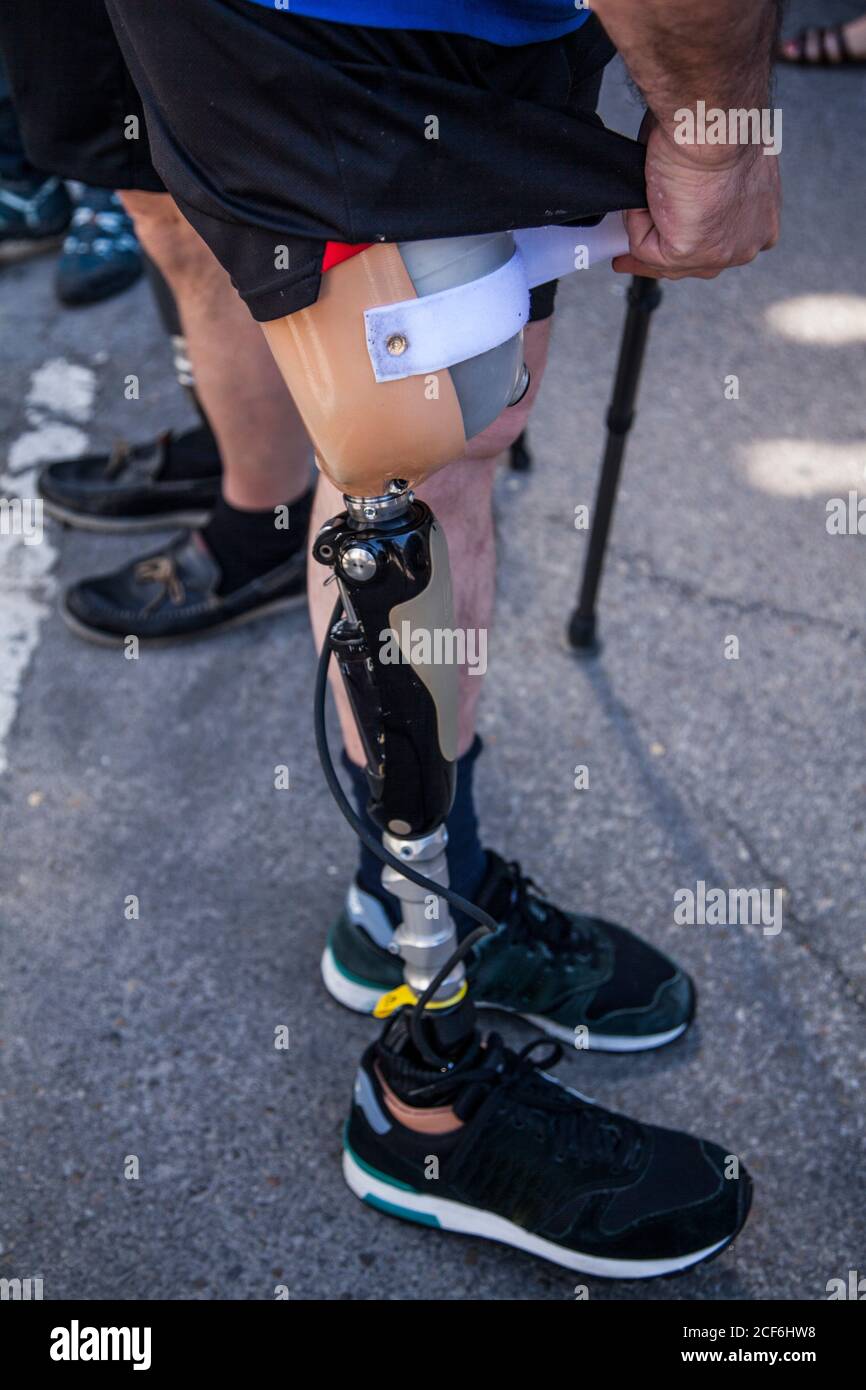 Leg amputation stump hi-res stock photography and images - Alamy