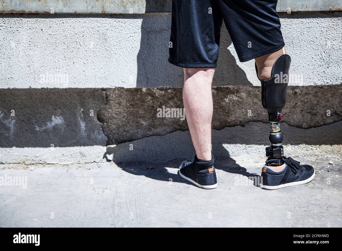 Leg Amputation Stump High Resolution Stock Photography and Images - Alamy