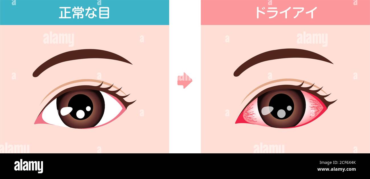 Illustration conjunctivitis eyes hi-res stock photography and images ...
