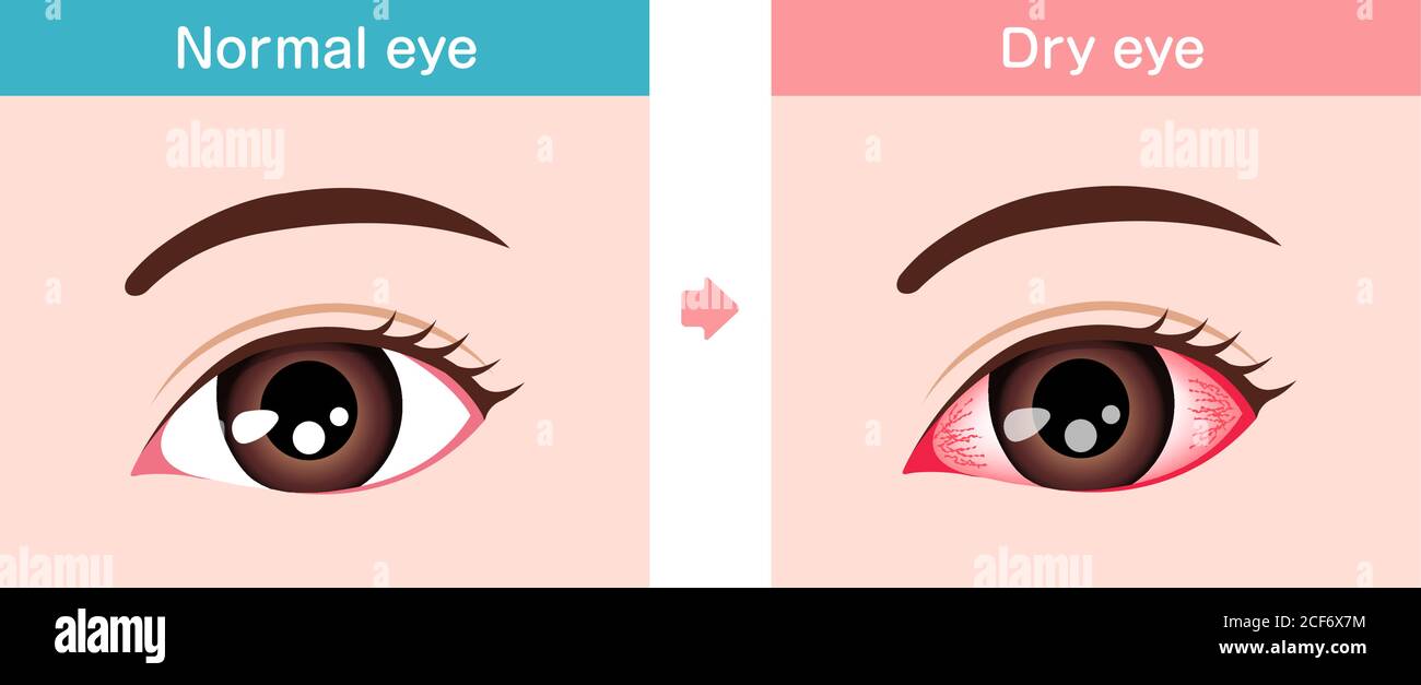 Comparison illustration between normal and dry eye Stock Vector Image ...