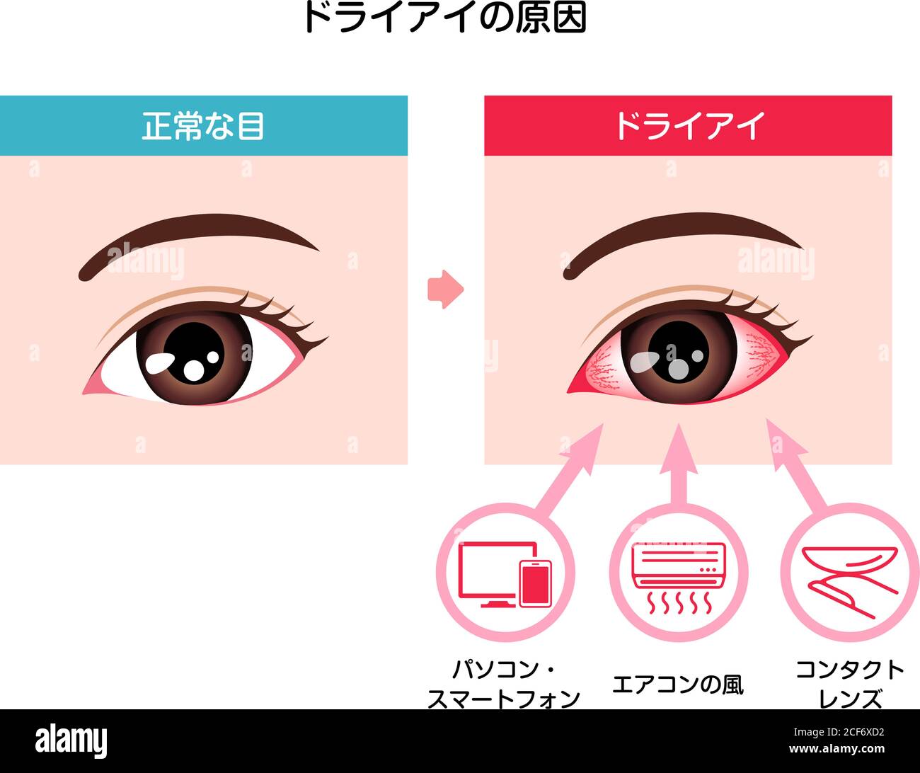 Causes of dry eye vector illustration (Japanese Stock Vector Image ...