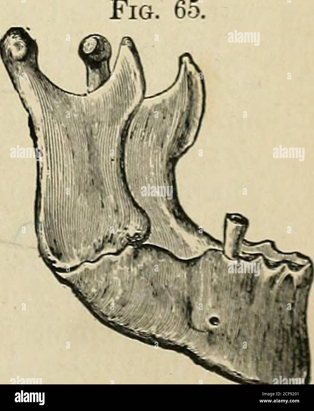 . A practical treatise on fractures and dislocations. hen the fracture ...