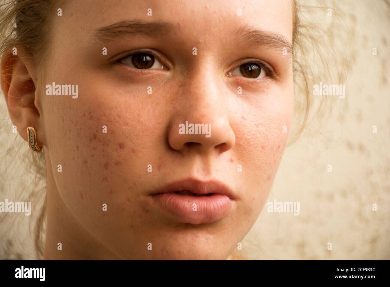 Girl with acne on the face.Acne on the face.Girl with problem skin ...