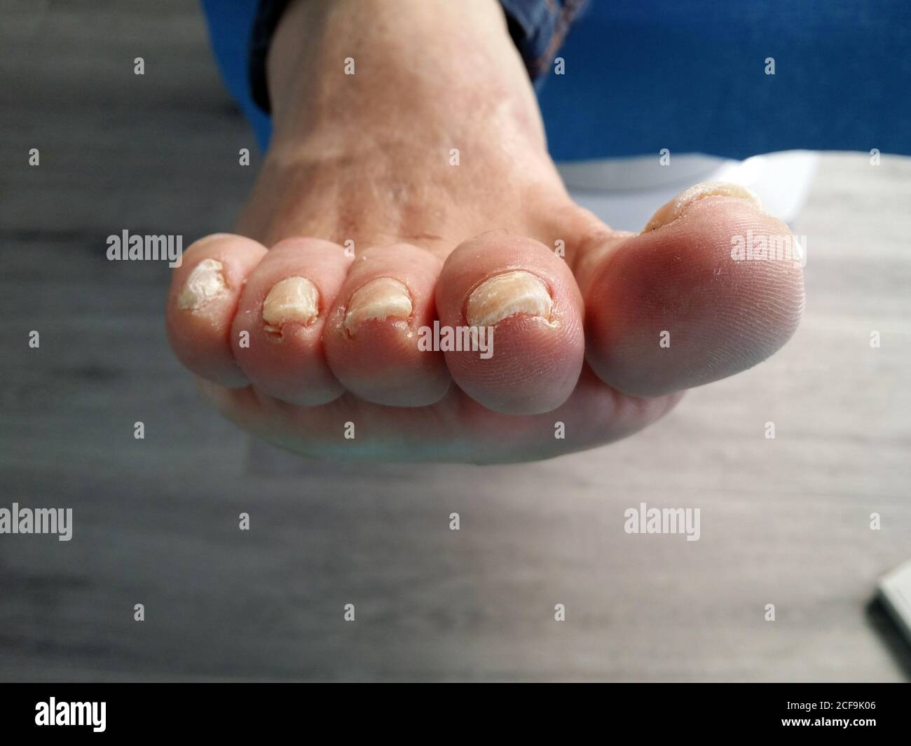 Inflamed big toe with ingrown toenail Stock Photo - Alamy