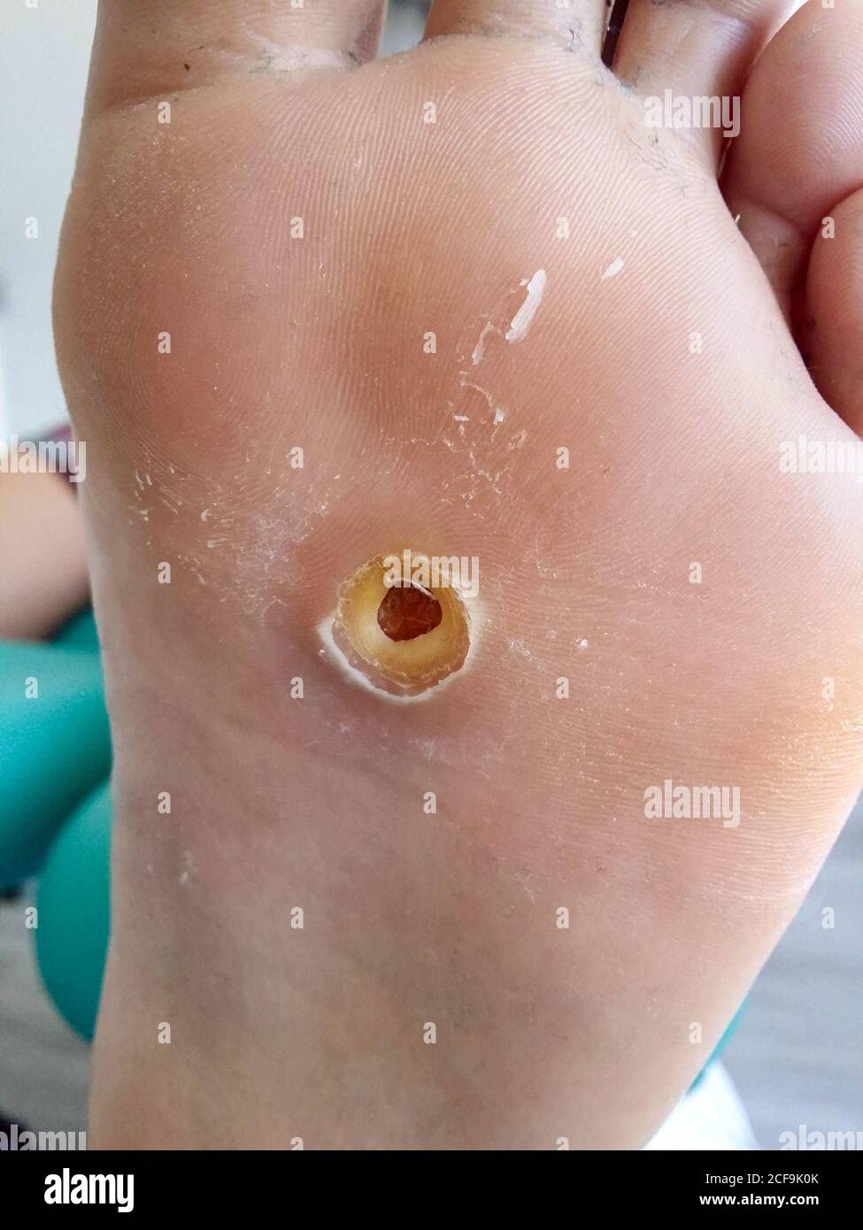 Wound healing hi-res stock photography and images - Alamy