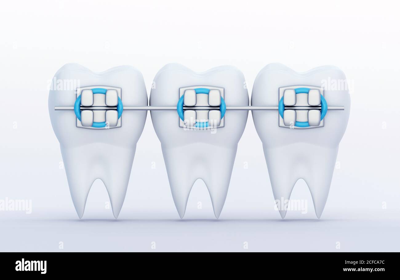 Three Teeth with Metal Braces. Care, Orthodontics and Dentistry symbols ...