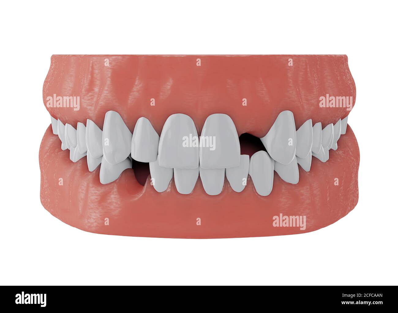jaw with missing front upper tooth deuce and lower tooth three on white ...