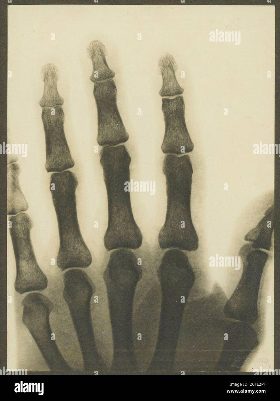 The first x ray picture hi-res stock photography and images - Alamy