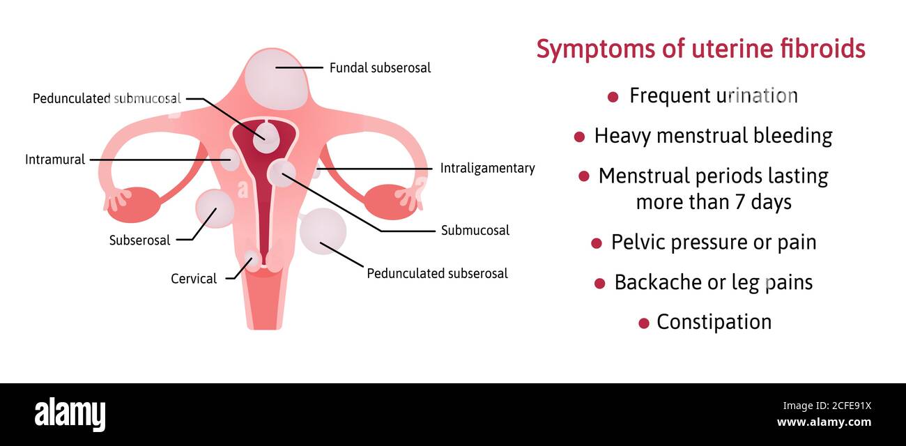 Uterine fibroids and its symptoms. List of symptoms. Different ...