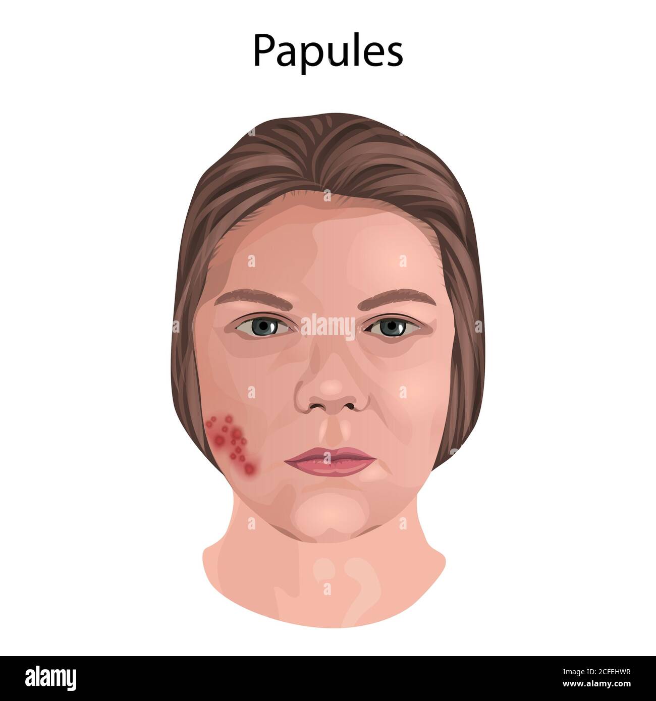 Papule Skin