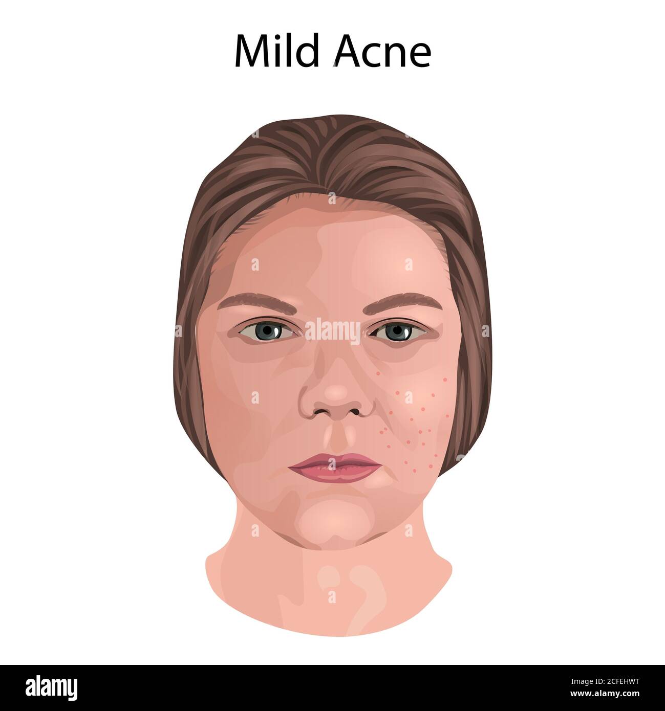 Mild acne, illustration Stock Photo - Alamy