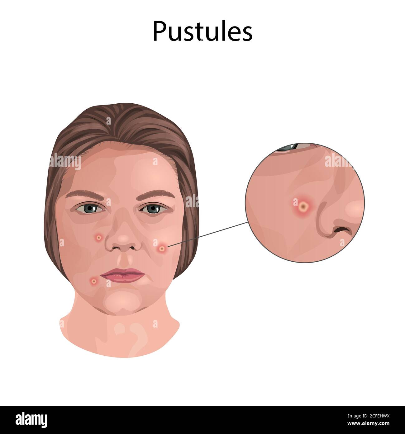 Pustules hi-res stock photography and images - Alamy