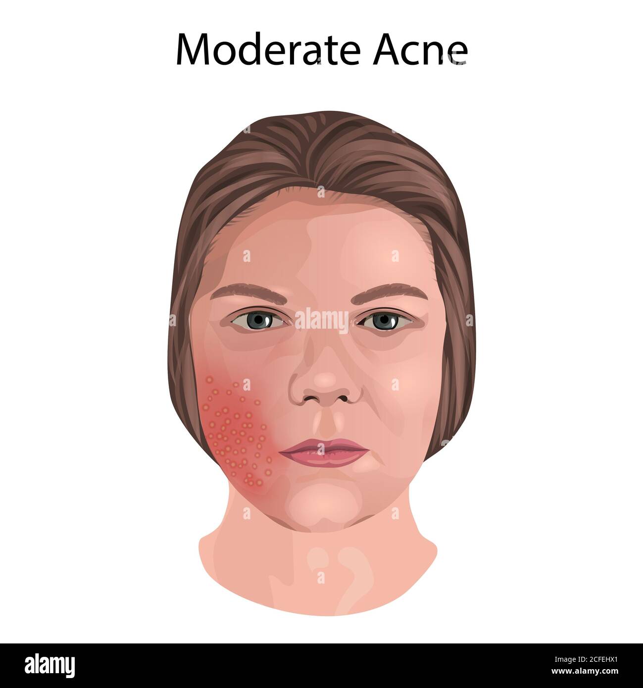 Acne illustration hi-res stock photography and images - Alamy