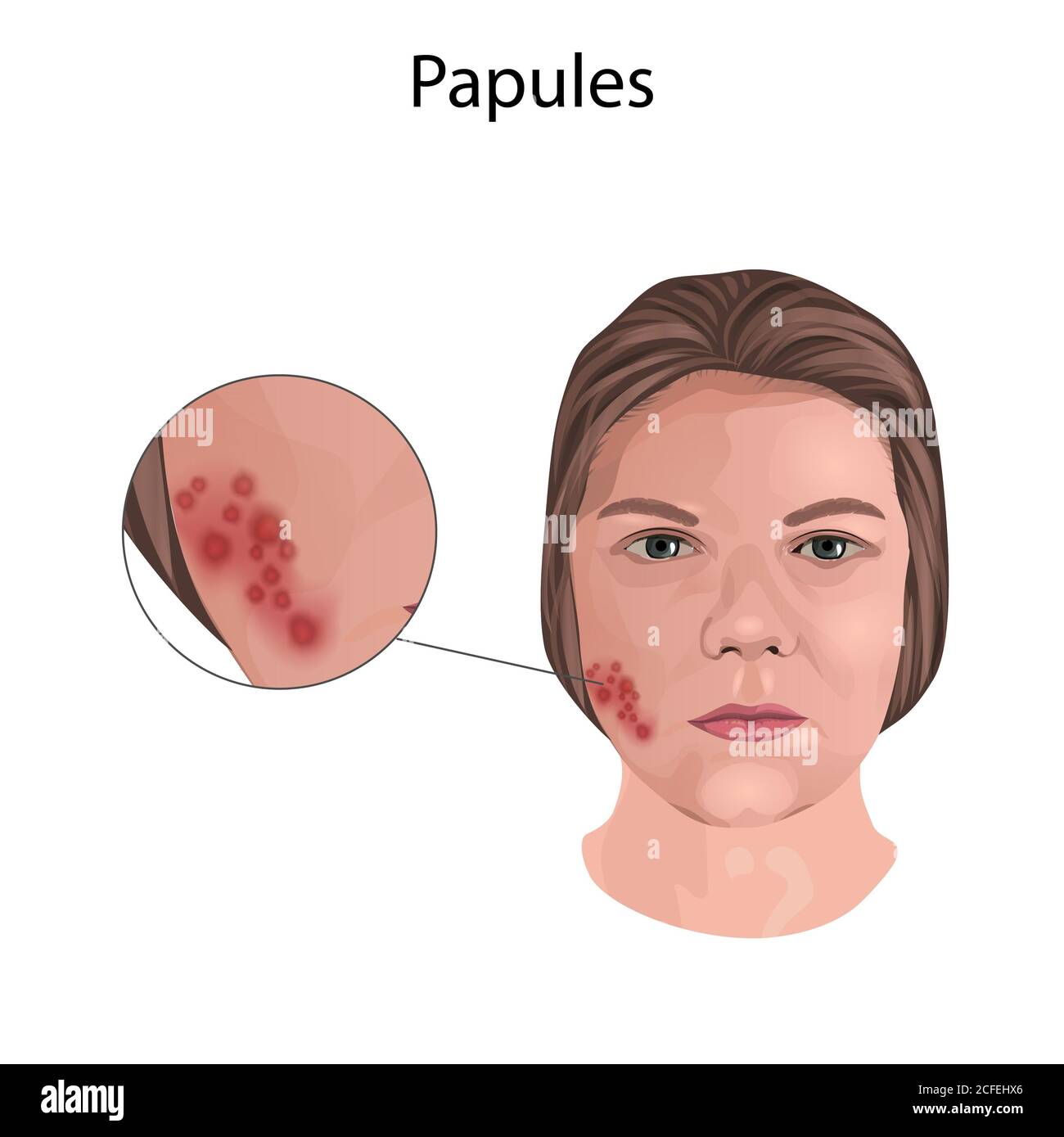 Papule Skin