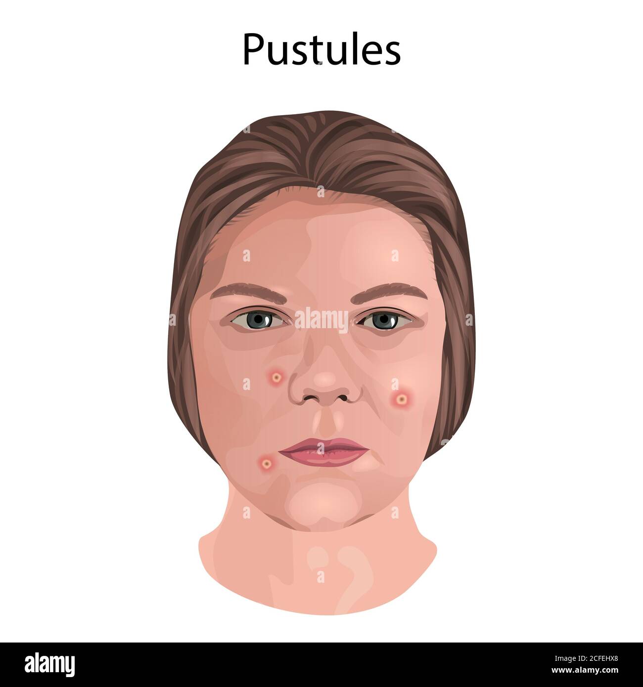 Pustules hi-res stock photography and images - Alamy