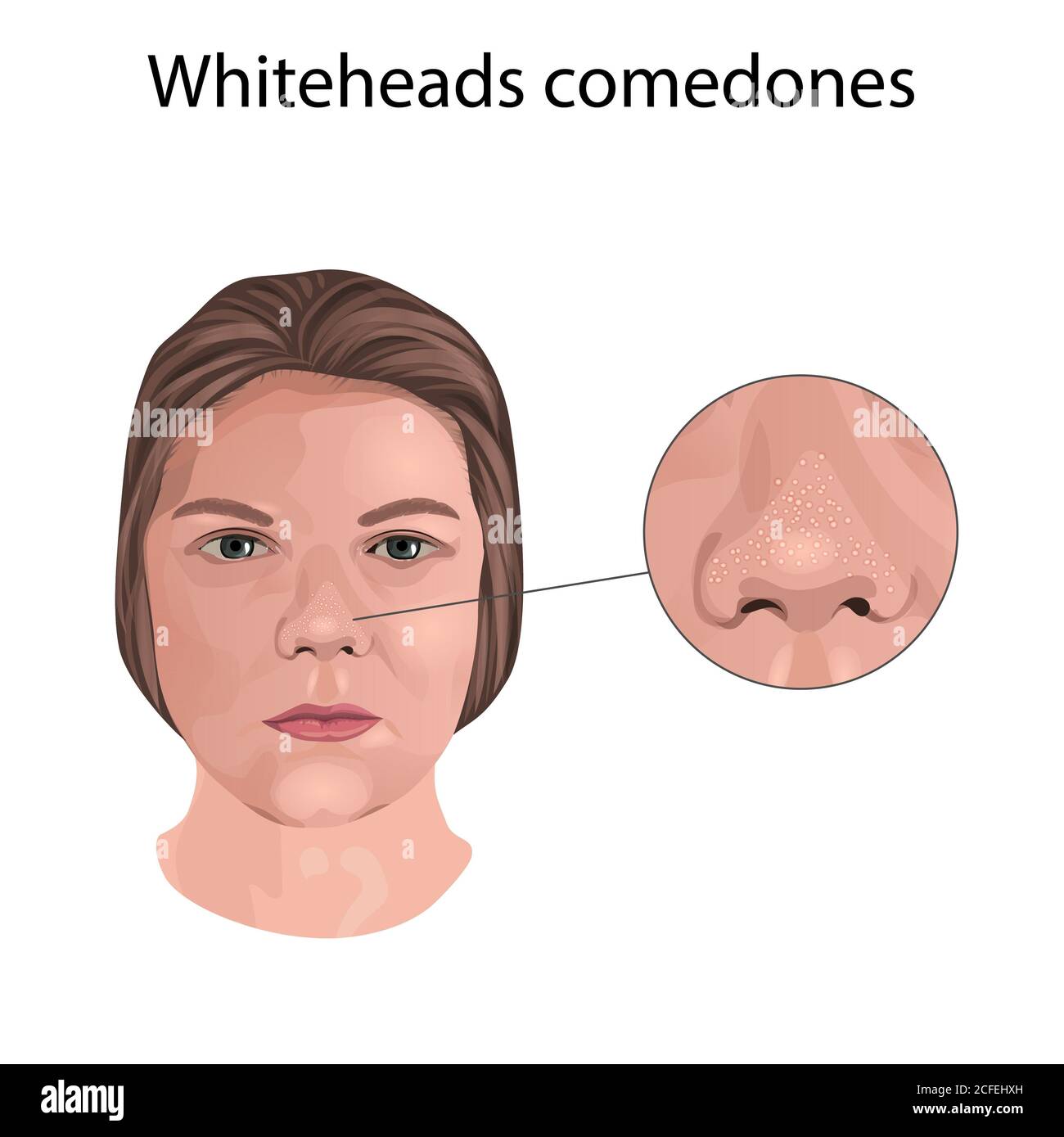 Whitehead comedones, illustration. Close-up view Stock Photo - Alamy