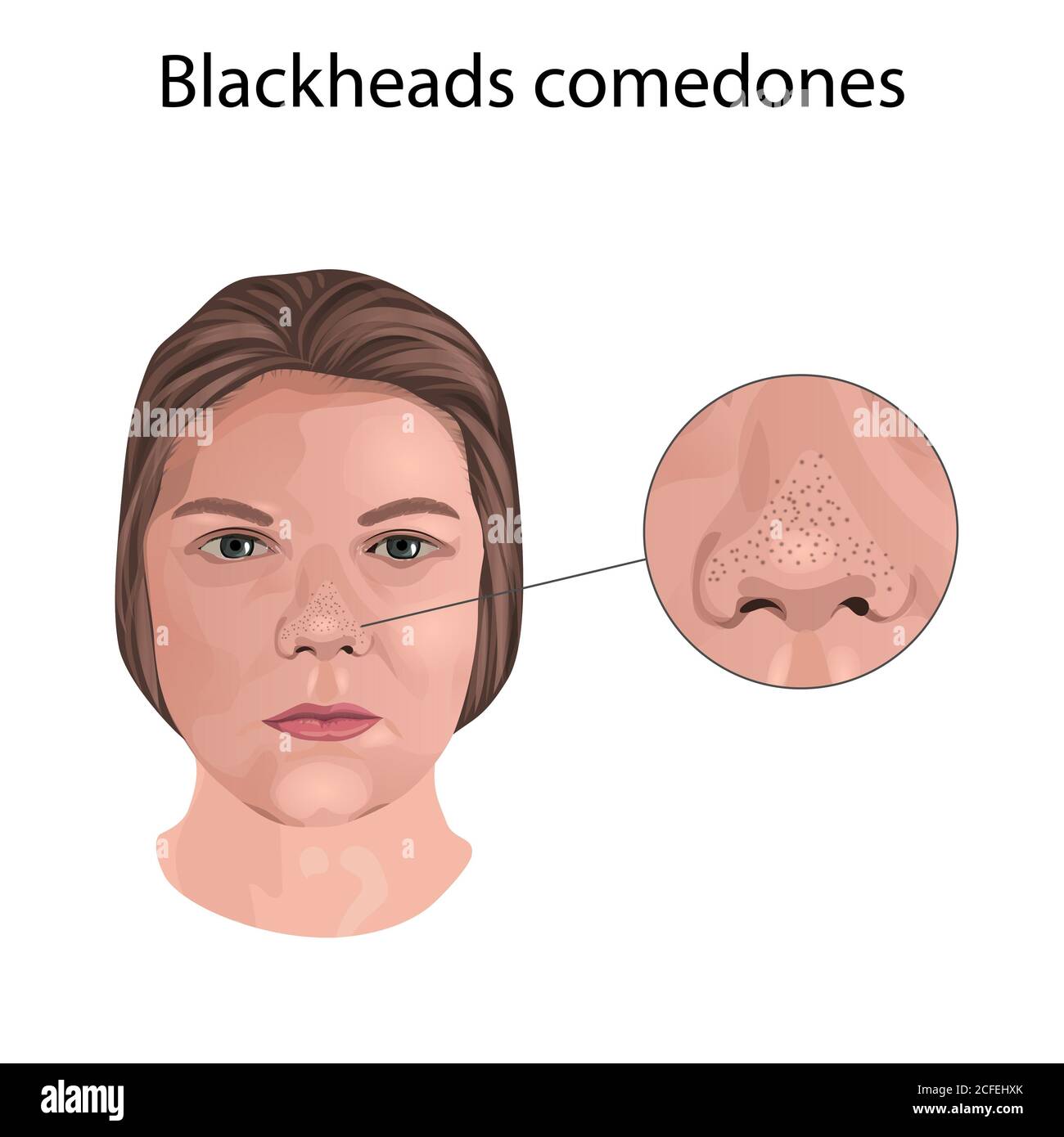 Blackhead comedones, illustration. Close-up view Stock Photo - Alamy