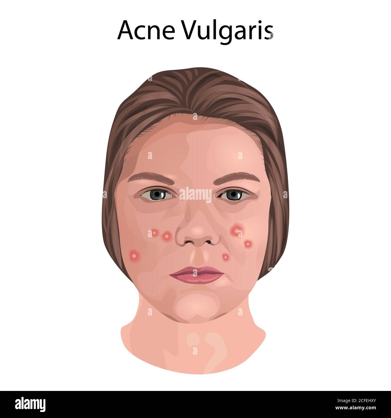 Acne vulgaris hi-res stock photography and images - Alamy