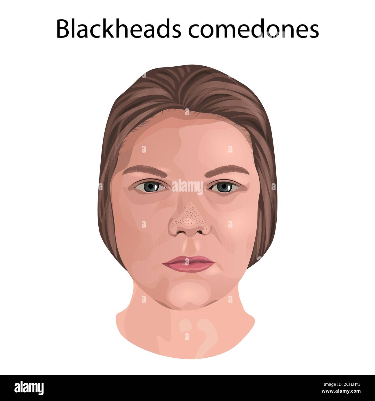 Blackhead comedones, illustration Stock Photo - Alamy