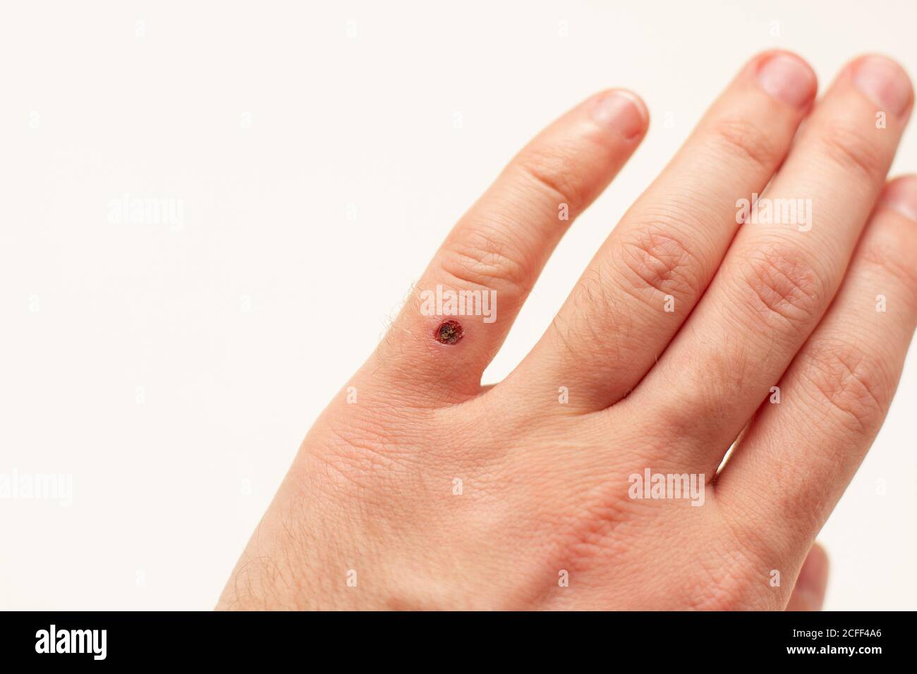 Wart finger hi-res stock photography and images - Alamy