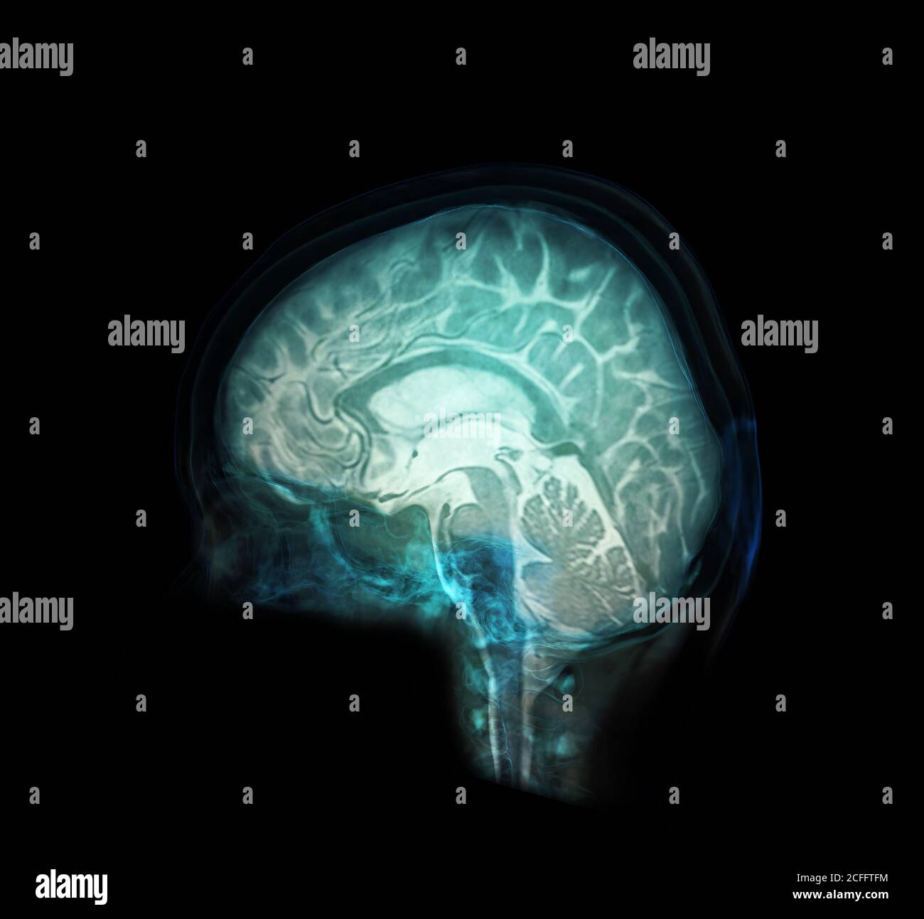 Mri scan sagittal brain color hi-res stock photography and images - Alamy