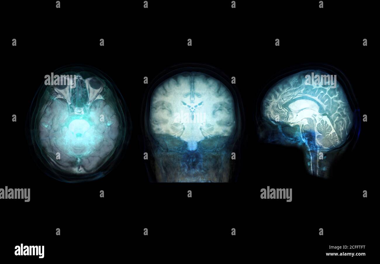 Mri Brain Color